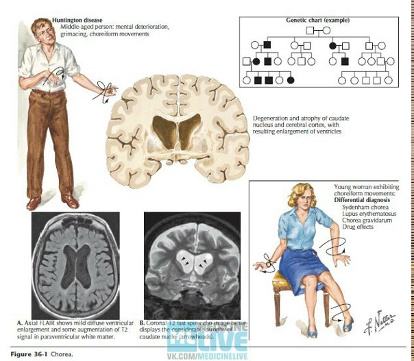 Chorea Causes In Adults - soccerfertodonne